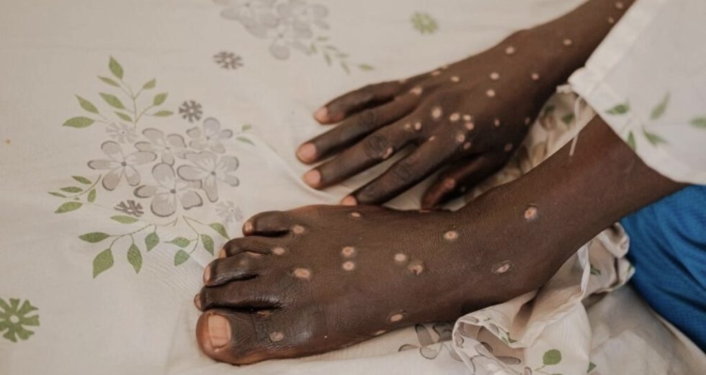 Moçambique regista 17 casos activos de Mpox – aimnews.org